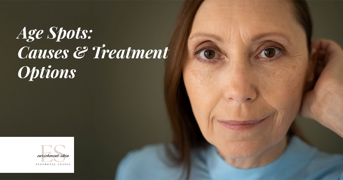 Age Spots: Causes & Treatment Options | Enrichment Skin Solutions