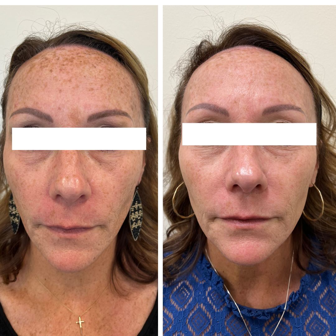 Difference Between Lumecca PEAK IPL and Laser Treatments | Enrichment ...